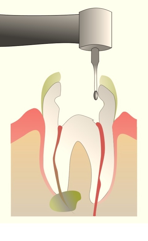 Demystifying Root Canal Treatment: An In-Depth Overview